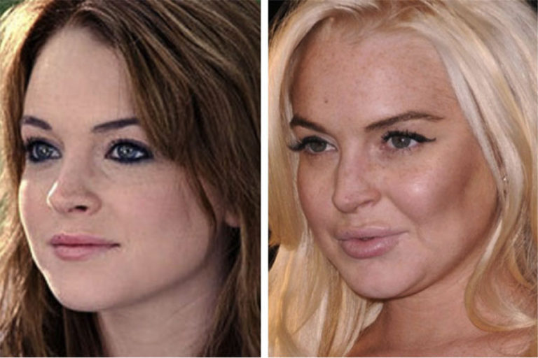 6 Botched Cosmetic Surgeries That Ruined Beauty of Famous People